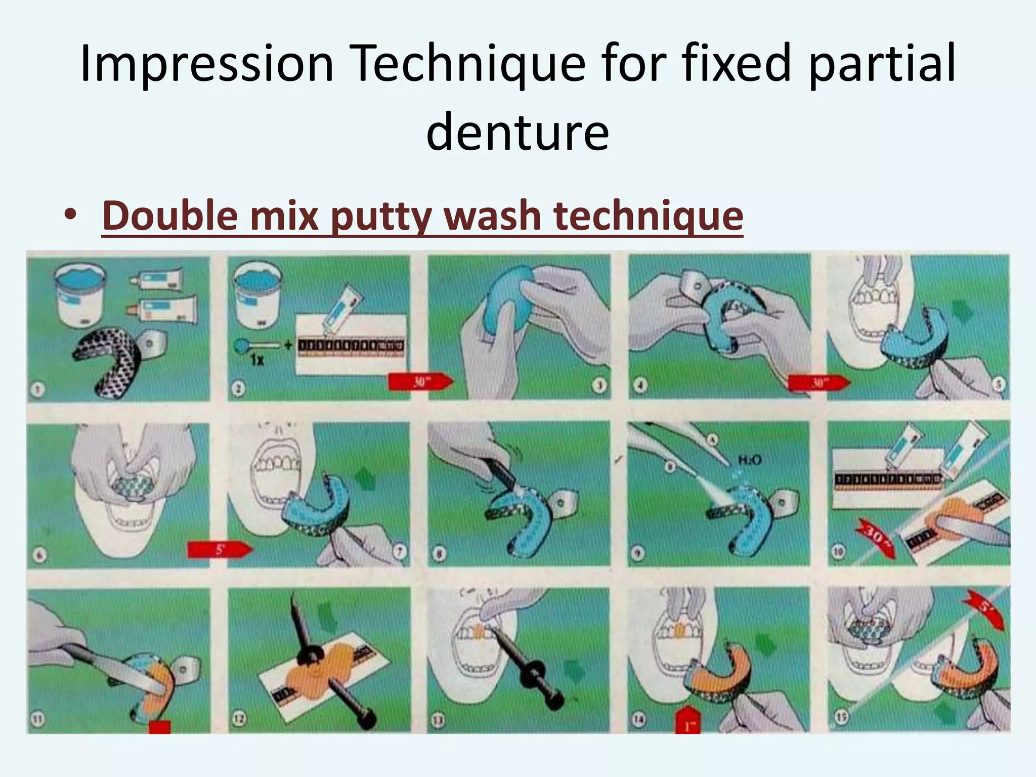 Design of a fixed Partial Denture (with Abutment Tooth Preparation) | PPTX