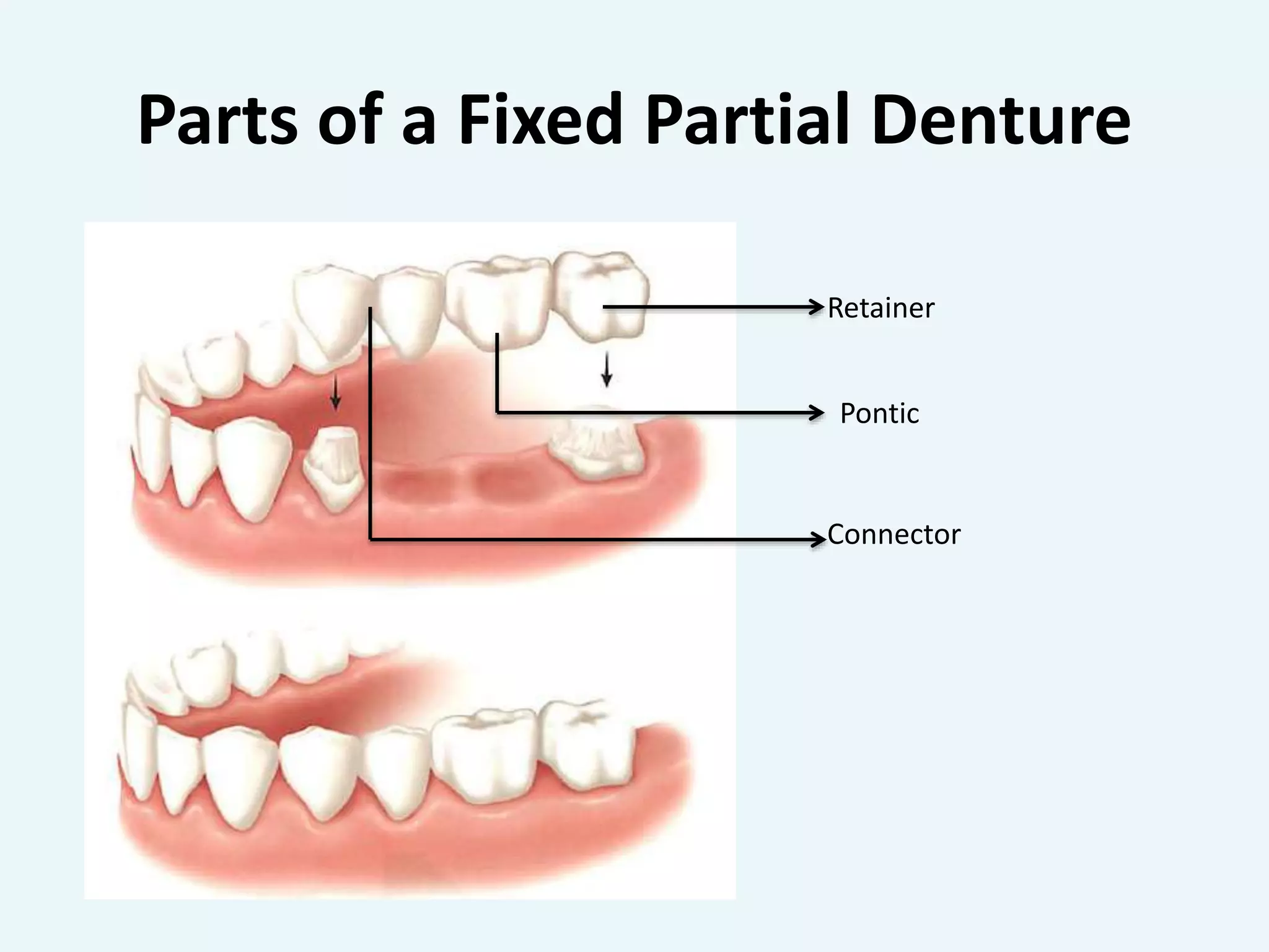 Design of a fixed Partial Denture (with Abutment Tooth Preparation) | PPTX