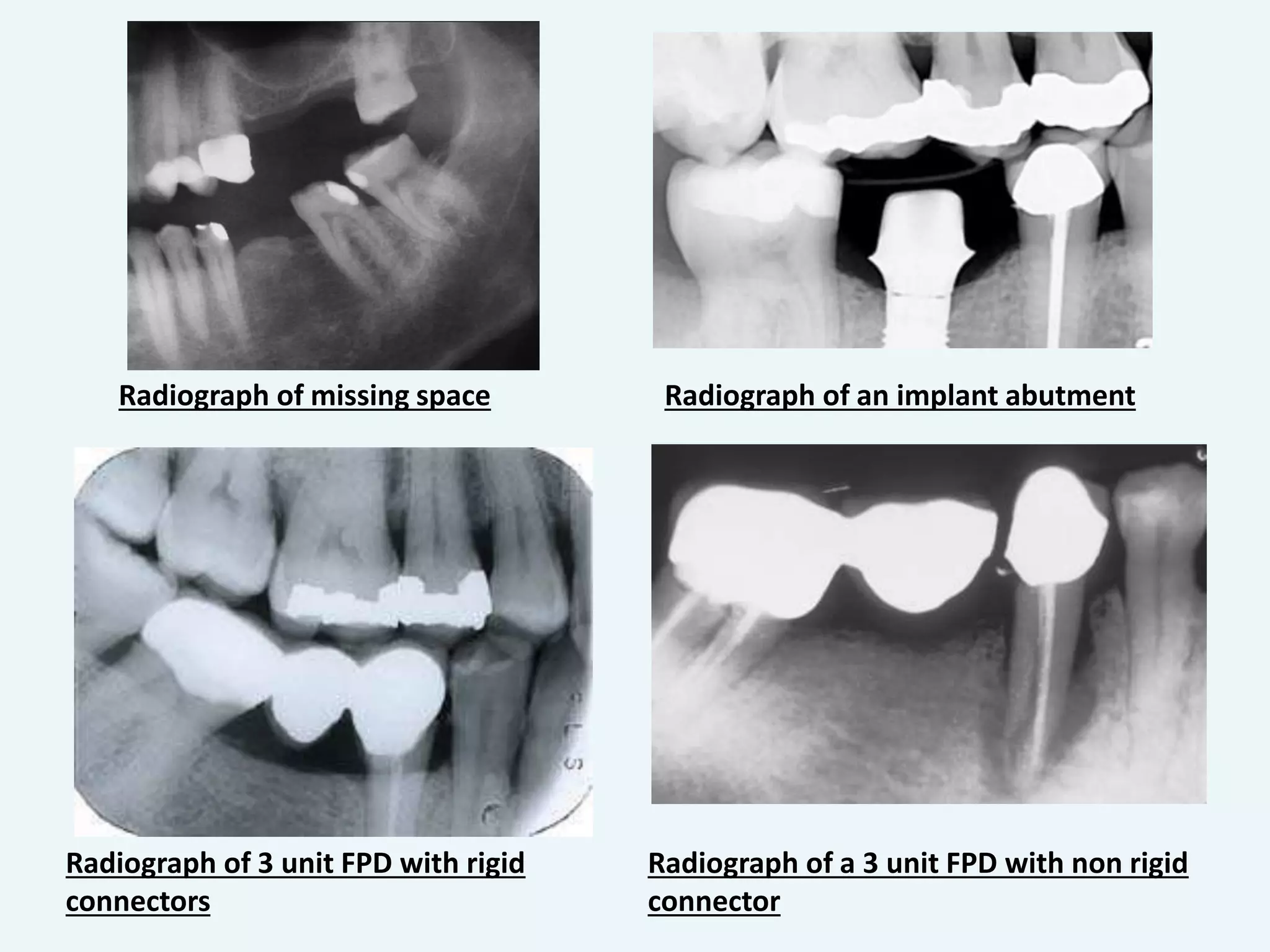 Design of a fixed Partial Denture (with Abutment Tooth Preparation) | PPTX