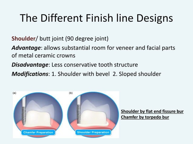 Design of a fixed Partial Denture (with Abutment Tooth Preparation) | PPTX | Dental Health ...