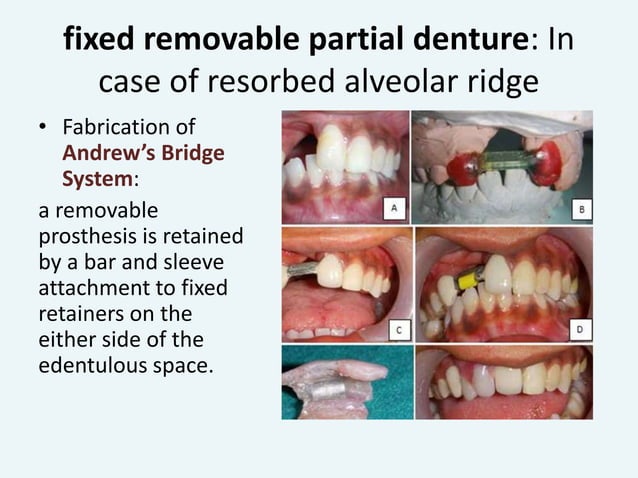Design of a fixed Partial Denture (with Abutment Tooth Preparation ...