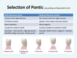 Design of a fixed Partial Denture (with Abutment Tooth Preparation) | PPT