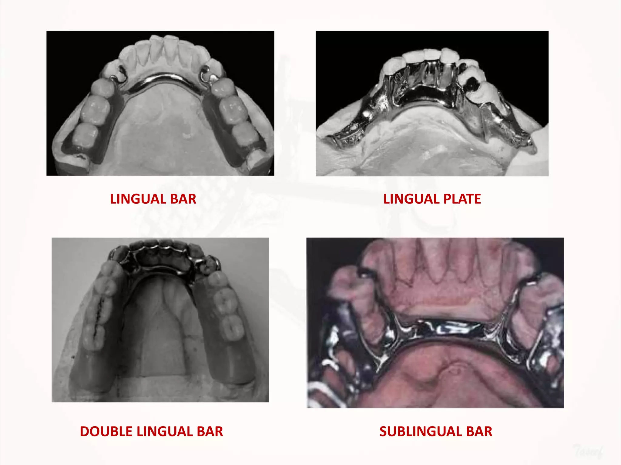 Designing a Removable Partial Denture (Kennedy's Classification) | PPTX