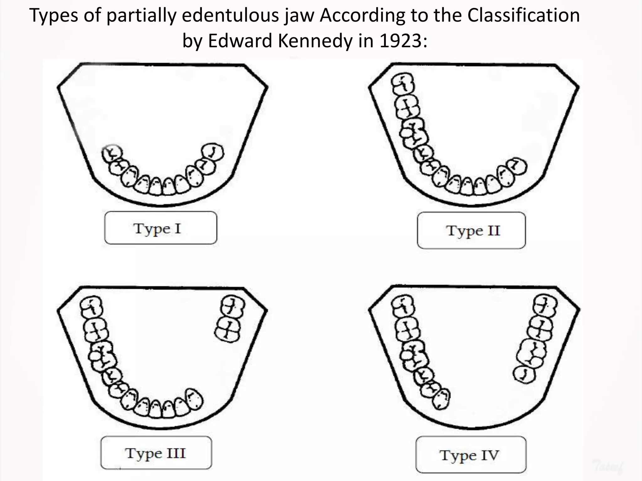 Designing a Removable Partial Denture (Kennedy's Classification) | PPTX