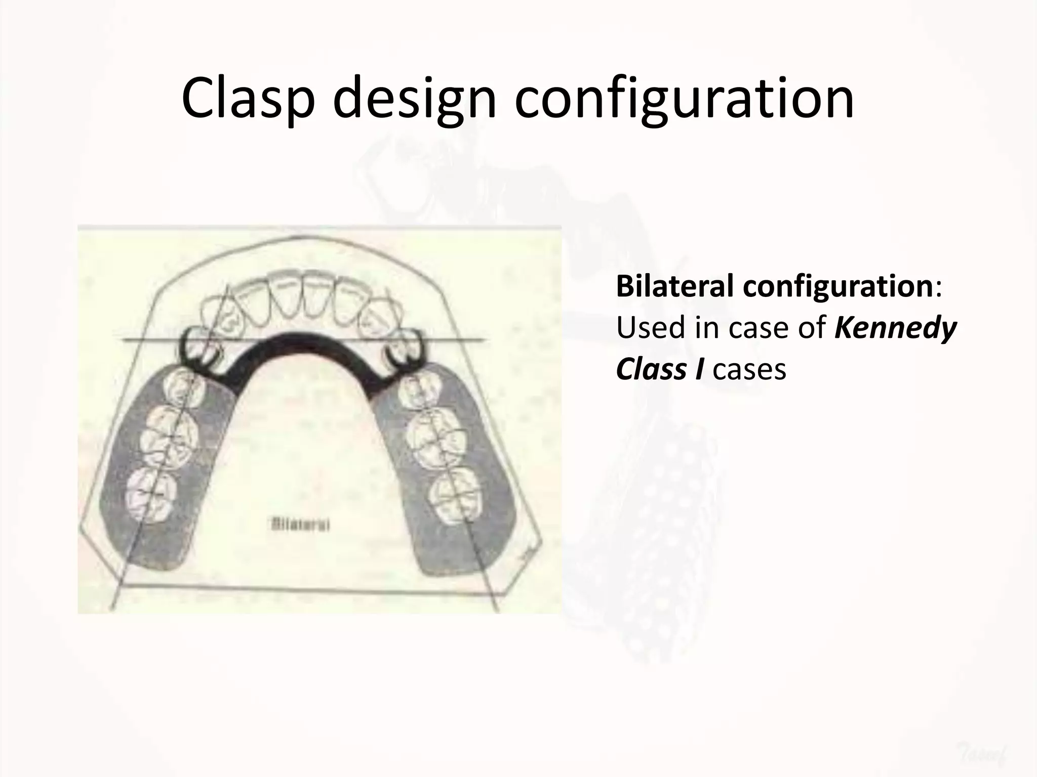 Designing a Removable Partial Denture (Kennedy's Classification) | PPTX