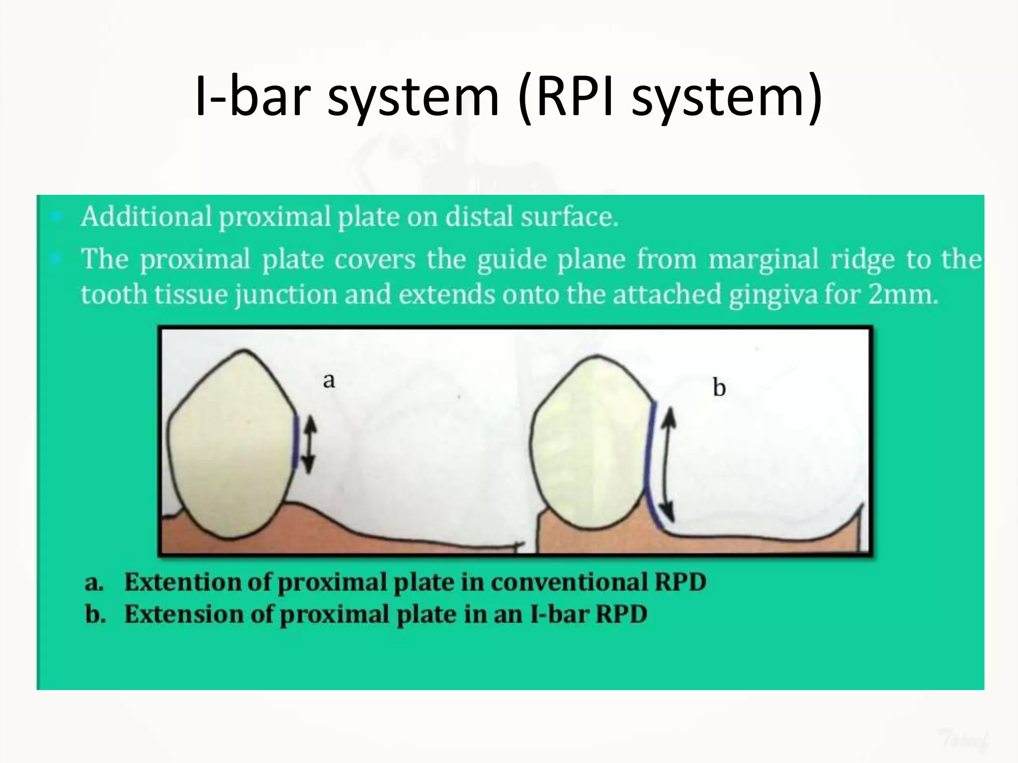 Designing a Removable Partial Denture (Kennedy's Classification) | PPTX