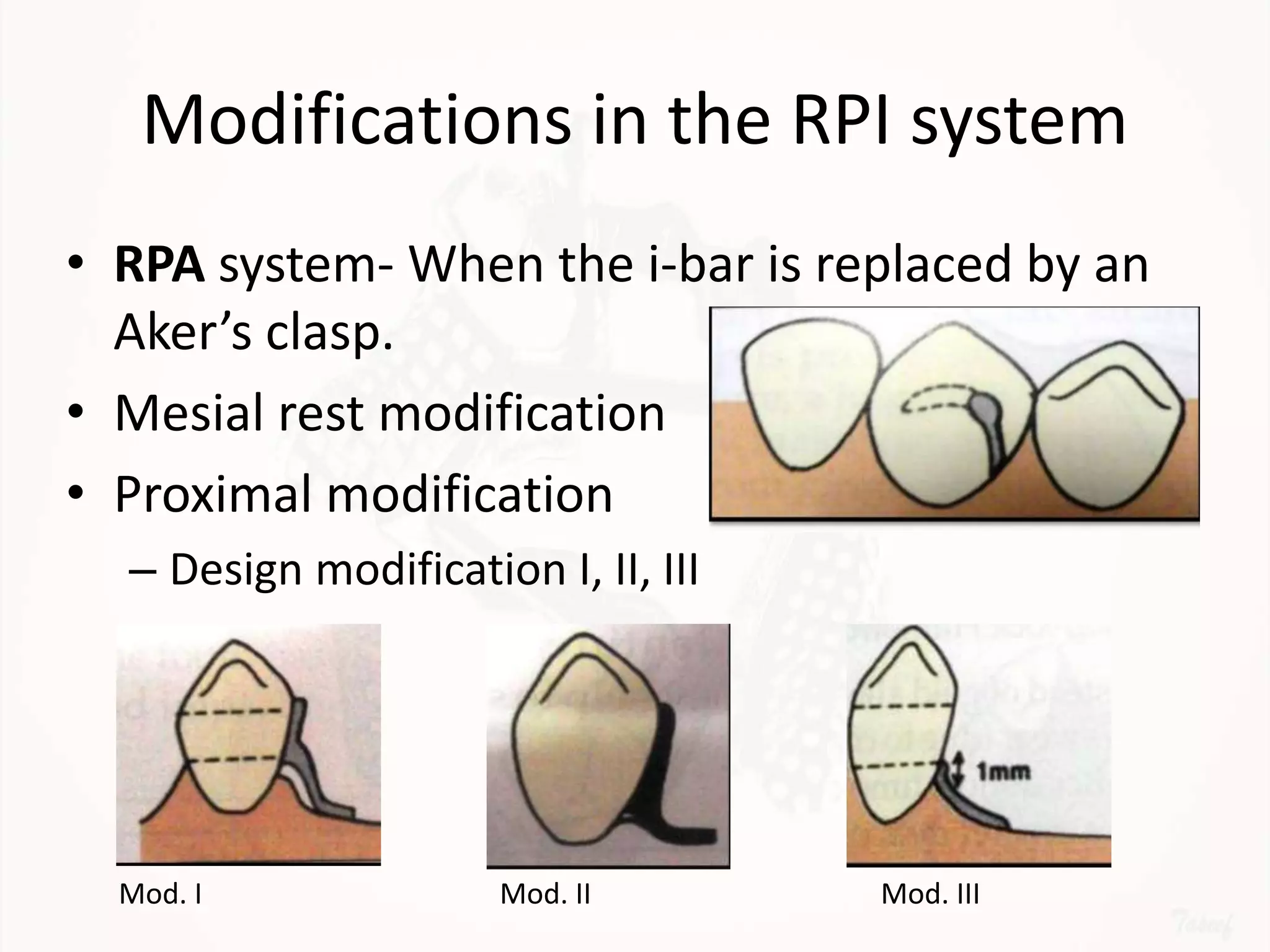 Designing a Removable Partial Denture (Kennedy's Classification) | PPTX