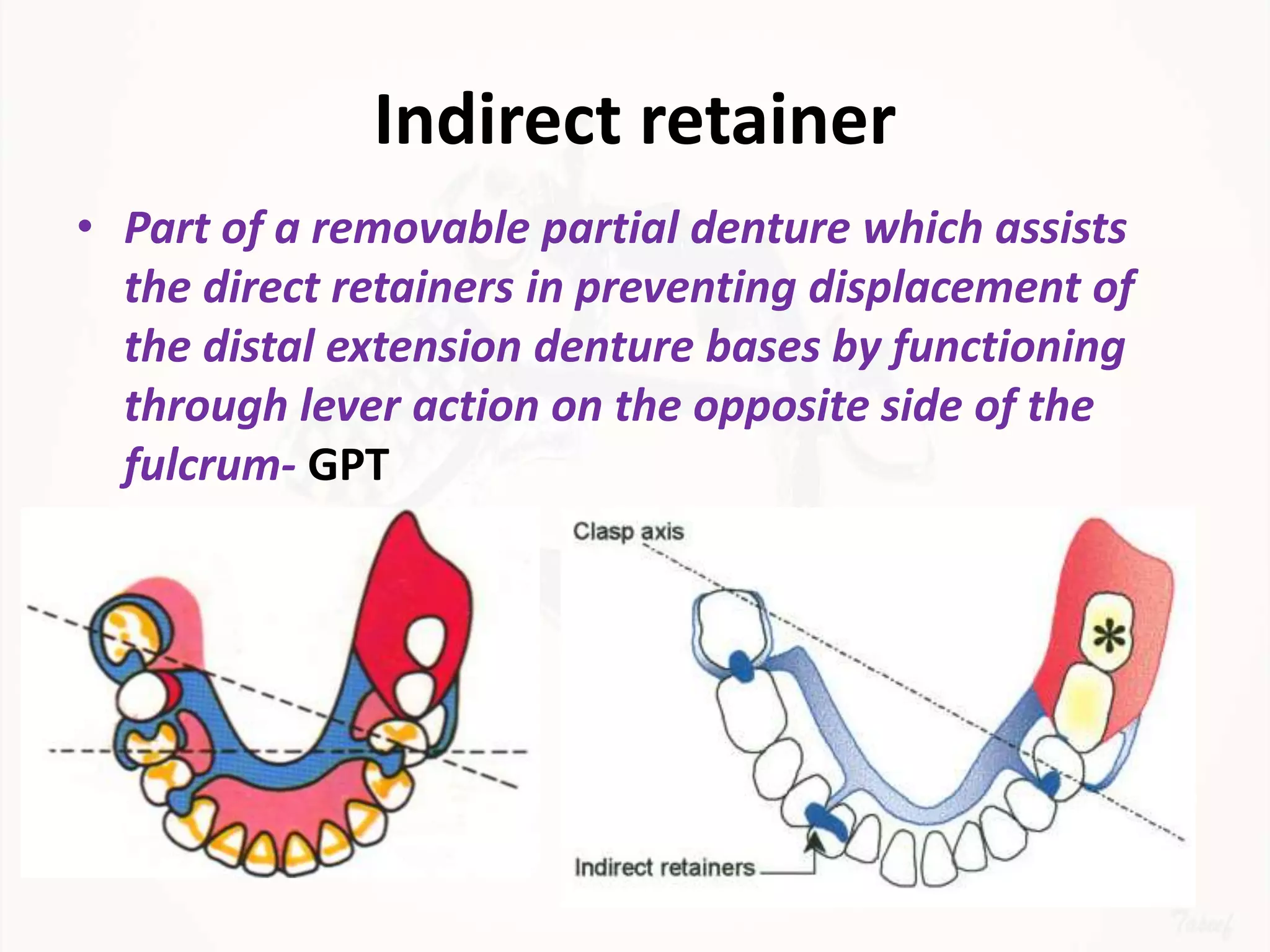 Designing a Removable Partial Denture (Kennedy's Classification) | PPTX
