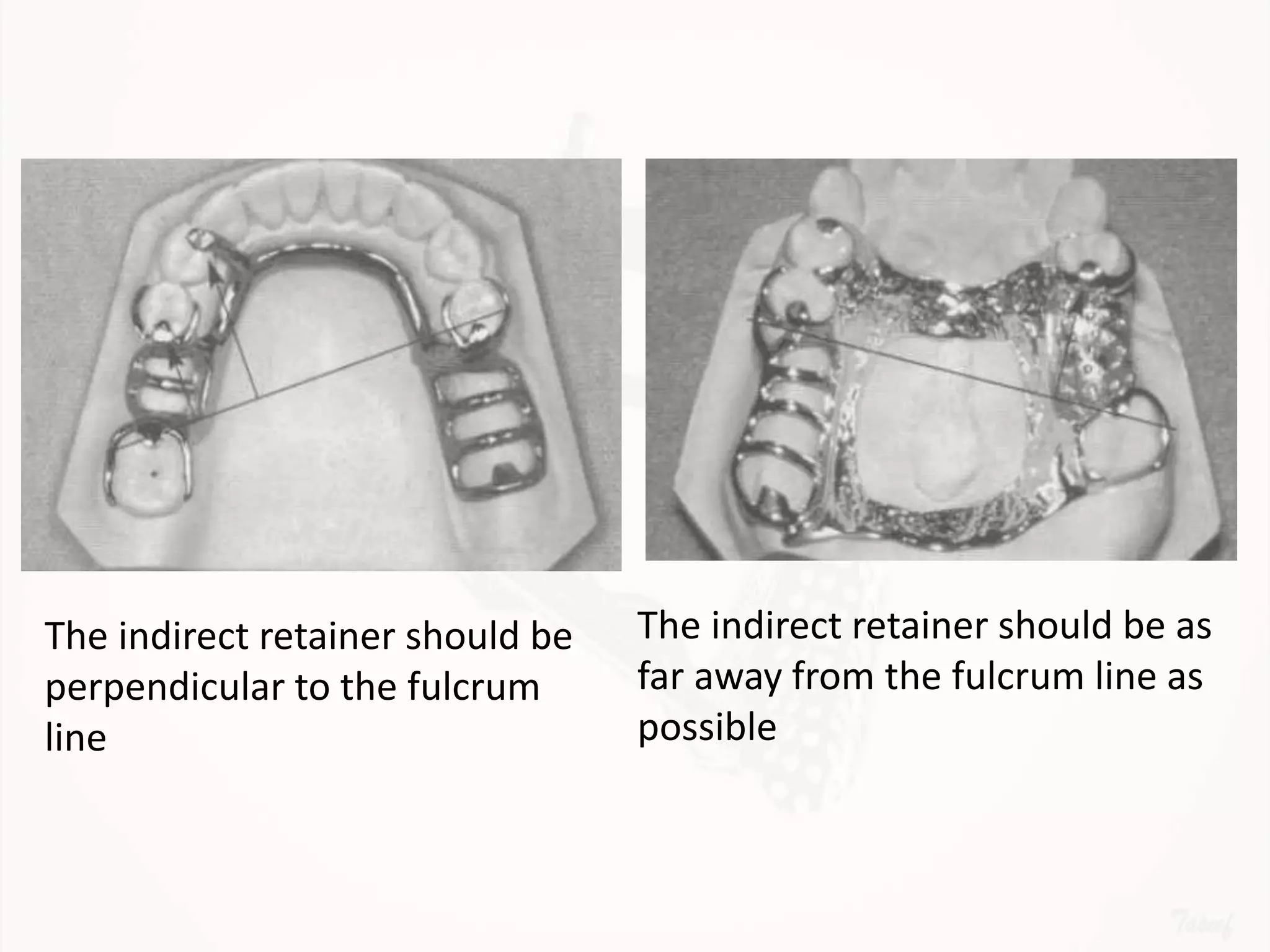 Designing a Removable Partial Denture (Kennedy's Classification) | PPTX