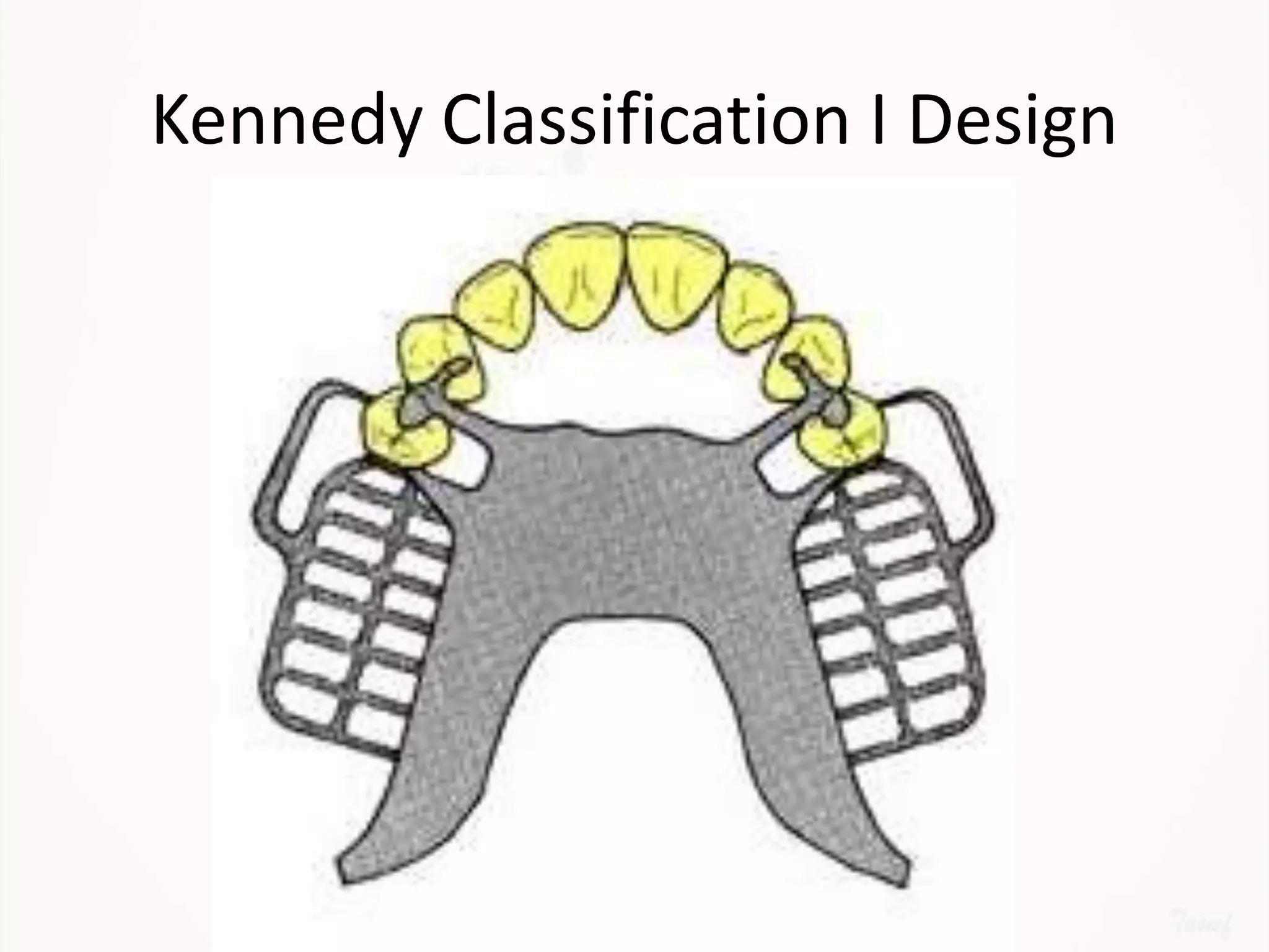 Designing a Removable Partial Denture (Kennedy's Classification) | PPTX