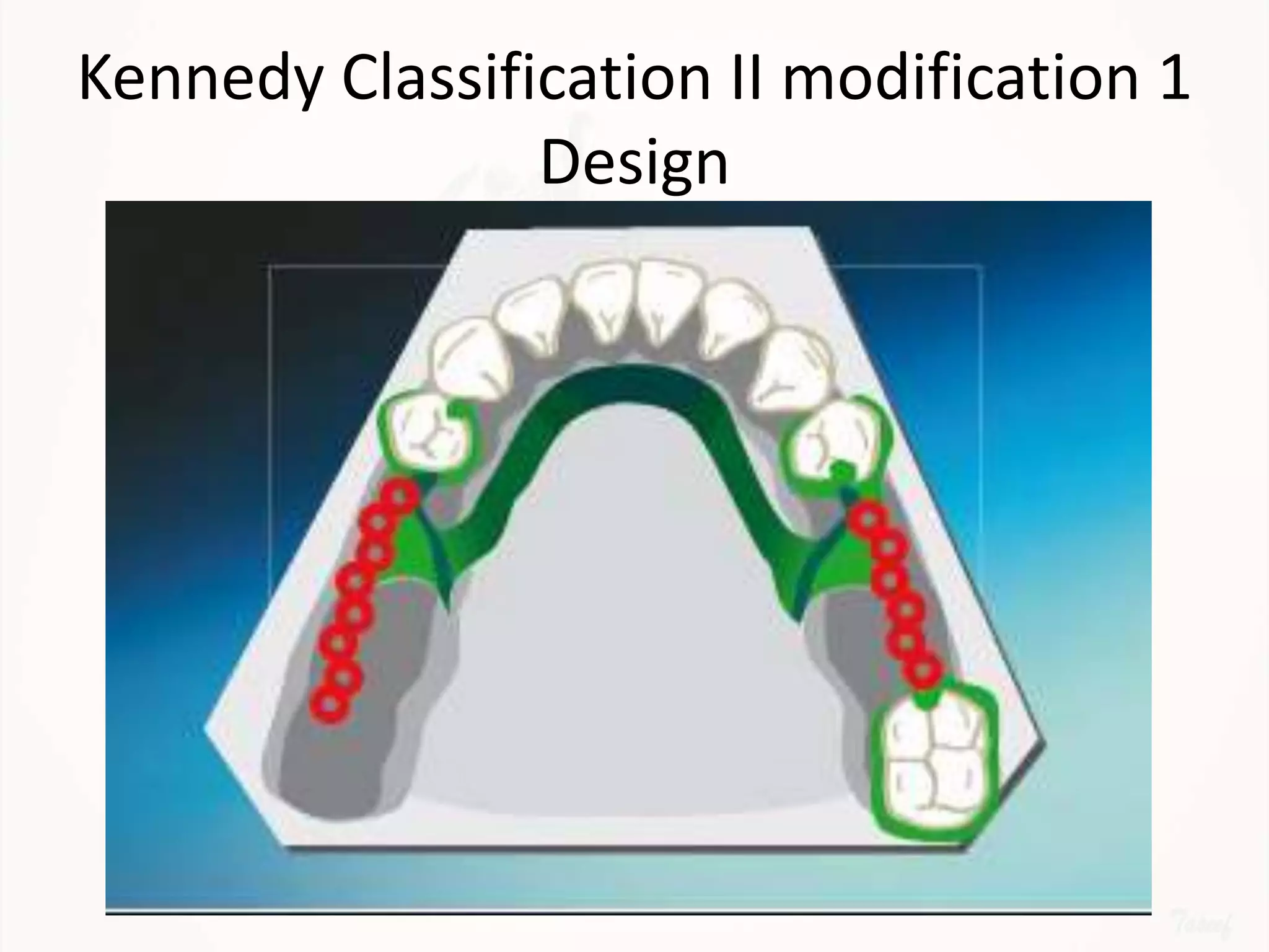 Designing a Removable Partial Denture (Kennedy's Classification) | PPTX