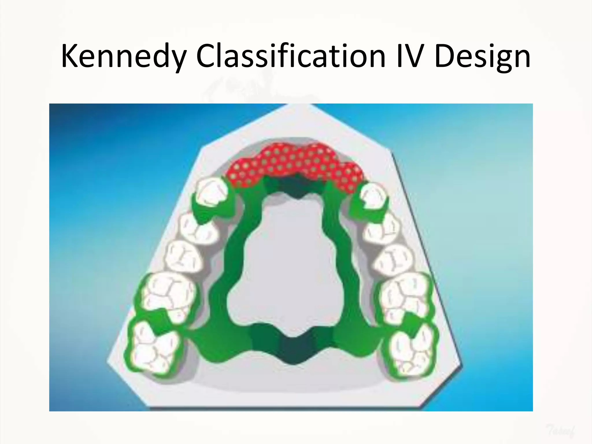 Designing a Removable Partial Denture (Kennedy's Classification) | PPTX