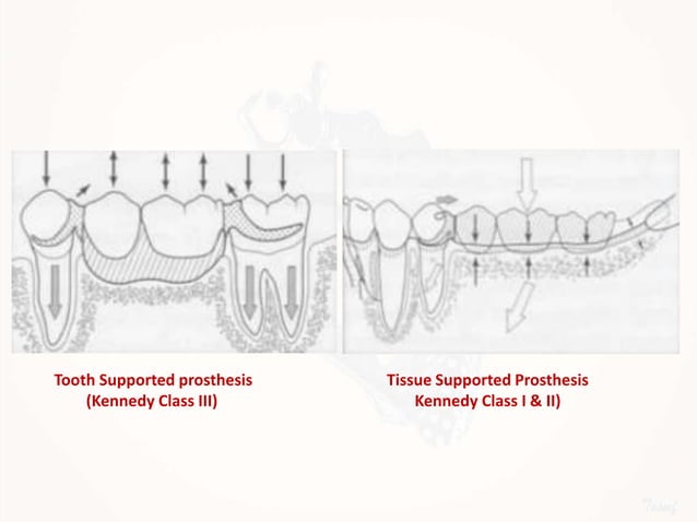 Designing a Removable Partial Denture (Kennedy's Classification) | PPTX