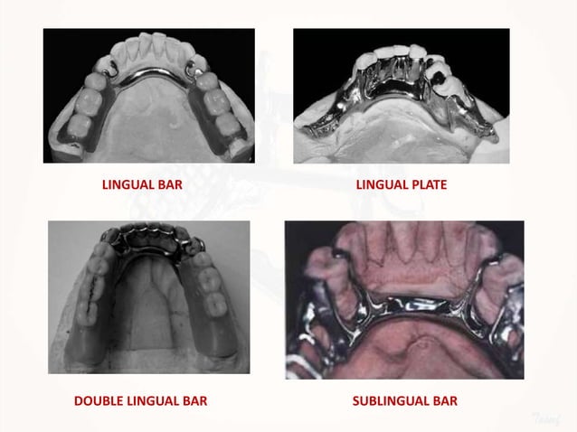 Designing a Removable Partial Denture (Kennedy's Classification) | PPTX