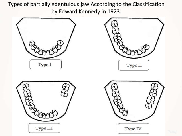 Designing a Removable Partial Denture (Kennedy's Classification) | PPTX