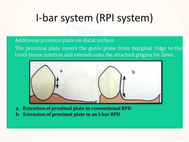 Designing a Removable Partial Denture (Kennedy's Classification) | PPTX