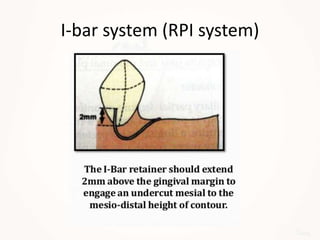 Designing a Removable Partial Denture (Kennedy's Classification) | PPTX