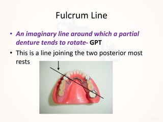Designing a Removable Partial Denture (Kennedy's Classification) | PPTX