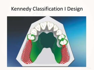 Designing a Removable Partial Denture (Kennedy's Classification) | PPTX
