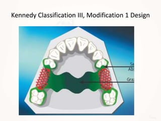 Designing a Removable Partial Denture (Kennedy's Classification) | PPTX