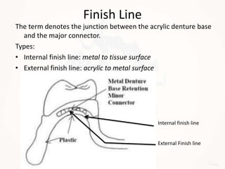 Designing a Removable Partial Denture (Kennedy's Classification) | PPT