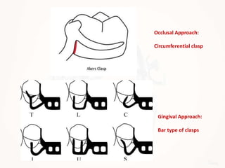 Designing a Removable Partial Denture (Kennedy's Classification) | PPT