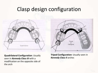 Designing a Removable Partial Denture (Kennedy's Classification) | PPT