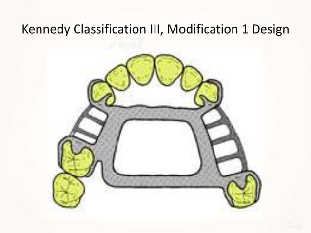 Designing a Removable Partial Denture (Kennedy's Classification)