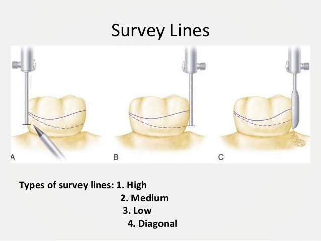 Designing a Removable Partial Denture (Kennedy's Classification)