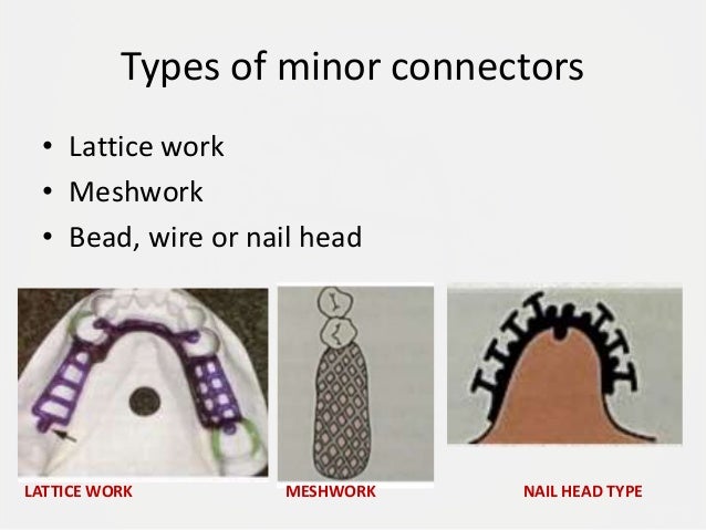 Designing a Removable Partial Denture (Kennedy's Classification)