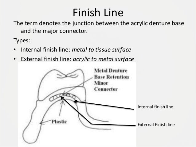 Designing a Removable Partial Denture (Kennedy's Classification)