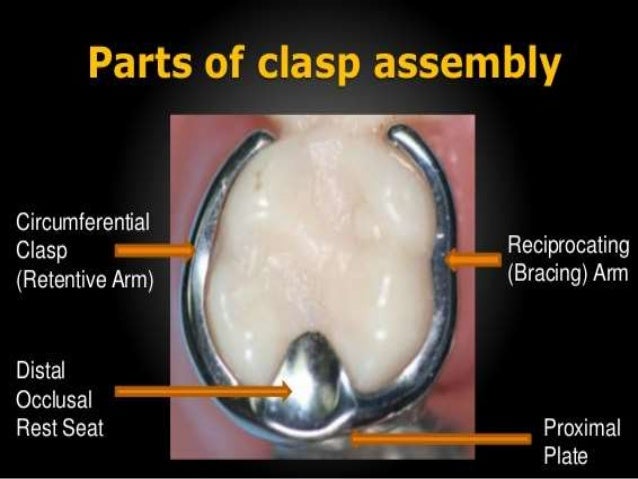 Designing a Removable Partial Denture (Kennedy's Classification)