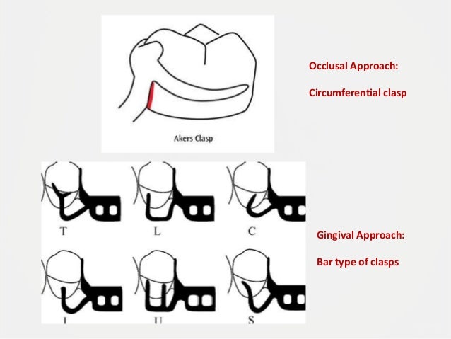 Designing a Removable Partial Denture (Kennedy's Classification)