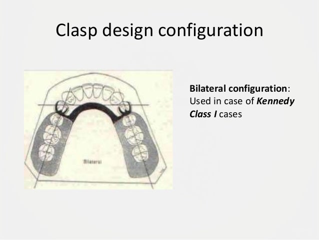 Designing a Removable Partial Denture (Kennedy's Classification)
