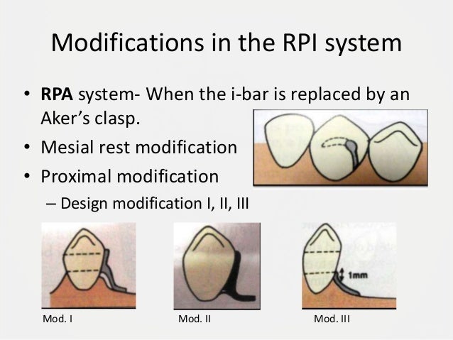Designing a Removable Partial Denture (Kennedy's Classification)