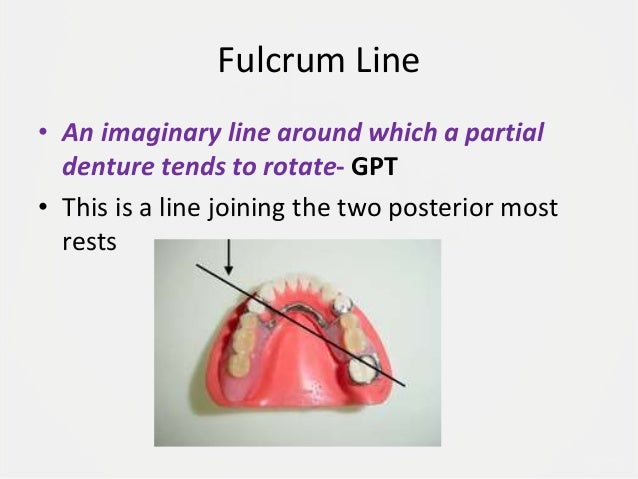 Designing a Removable Partial Denture (Kennedy's Classification)