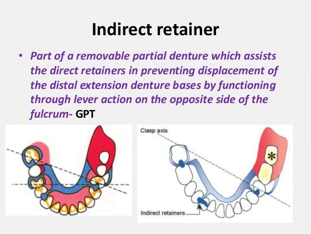 Designing a Removable Partial Denture (Kennedy's Classification)
