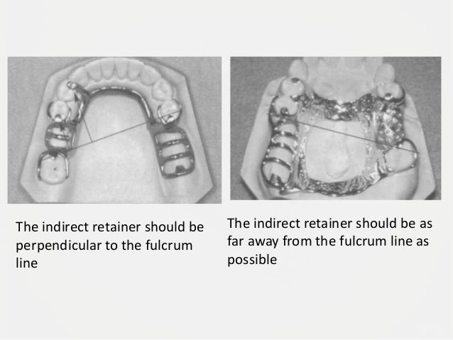 Designing a Removable Partial Denture (Kennedy's Classification)