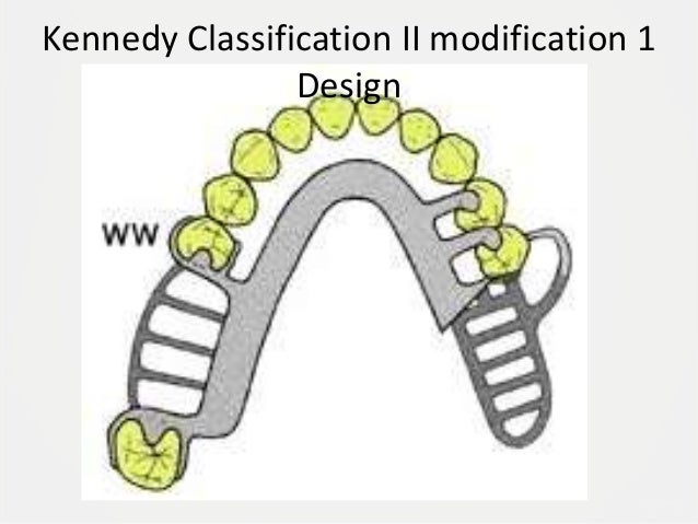 Designing A Removable Partial Denture Kennedys Classification