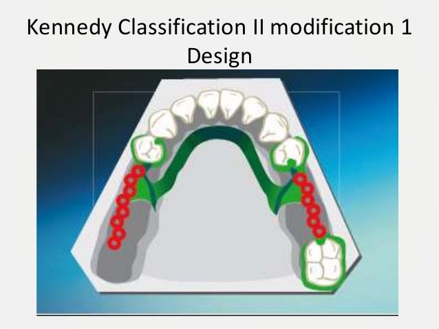 Designing A Removable Partial Denture Kennedys Classification