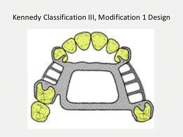 Designing a Removable Partial Denture (Kennedy's Classification)
