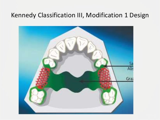 Designing a Removable Partial Denture (Kennedy's Classification)