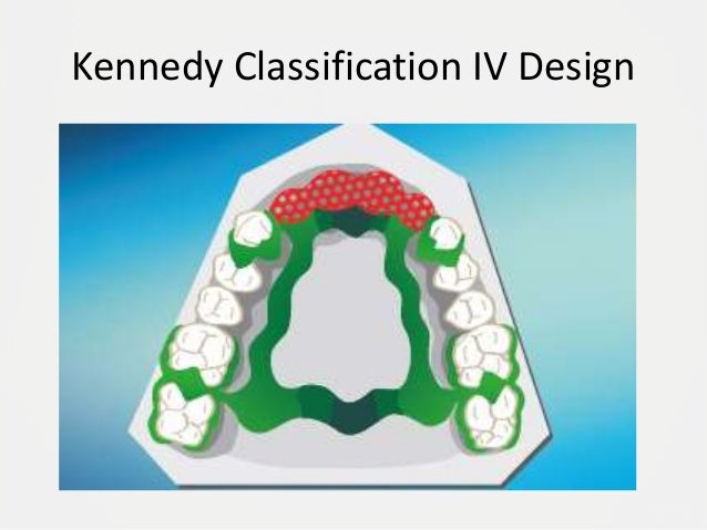 Designing a Removable Partial Denture (Kennedy's Classification)