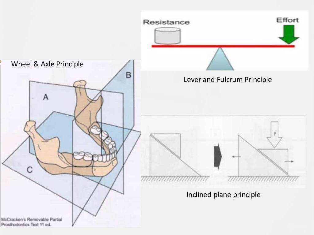 Designing a Removable Partial Denture (Kennedy's Classification)