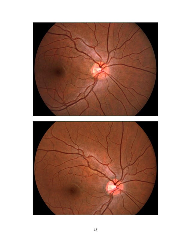 Design of imaging system of fundus camera.pdf | Eye and Vision ...