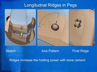 Design Of Knee Prosthesis and Analysis-Ashish Sharma | PDF