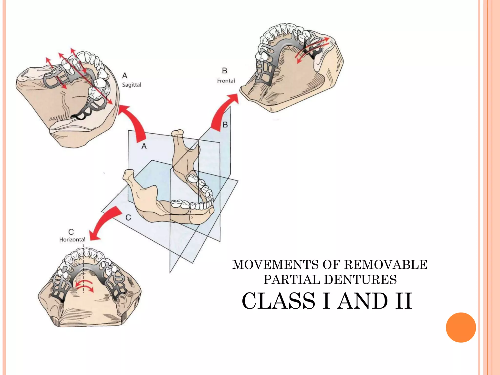 Design of removable partial denture | PPT