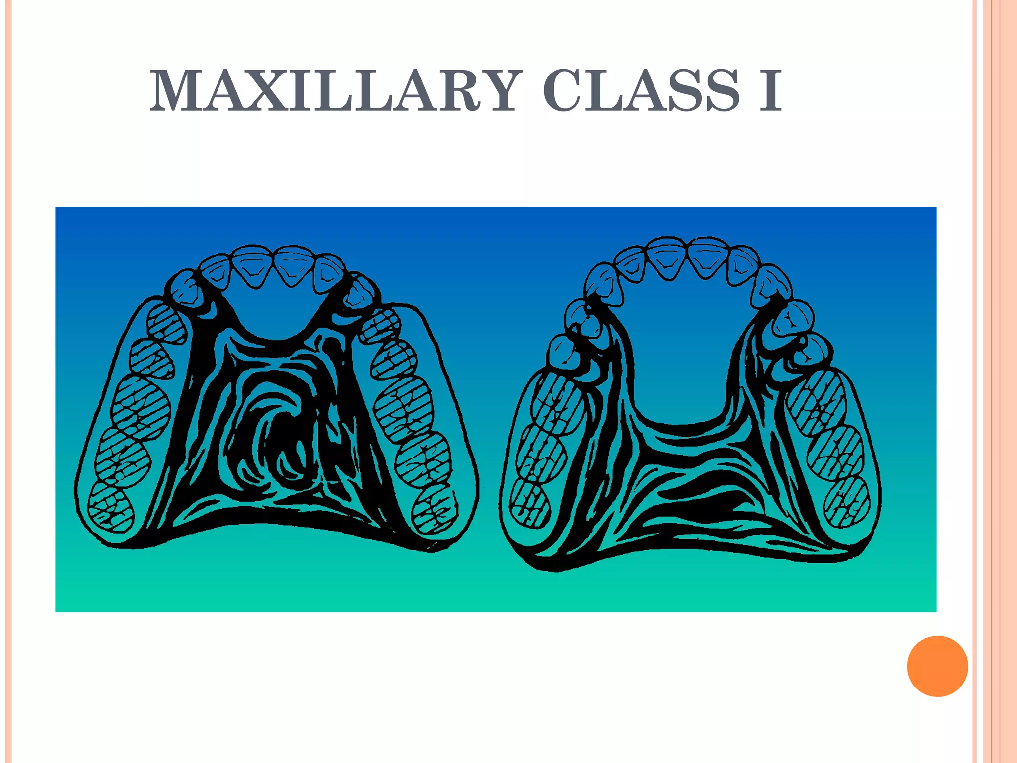 Design of removable partial denture | PPT