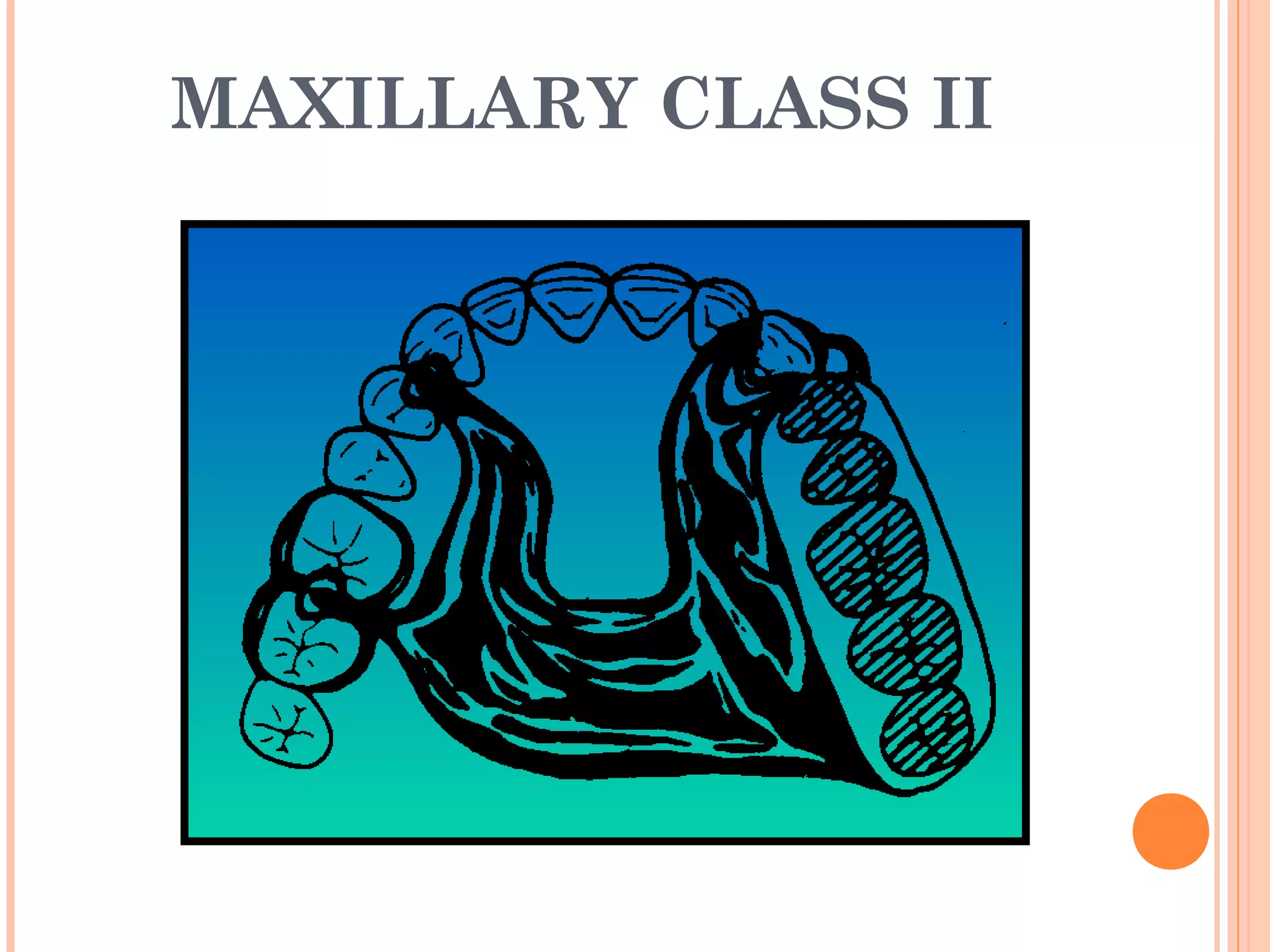 Design of removable partial denture | PPT