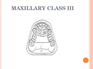 Design of removable partial denture | PPT